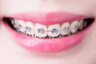 Dental Braces - Springleaf Healthcare